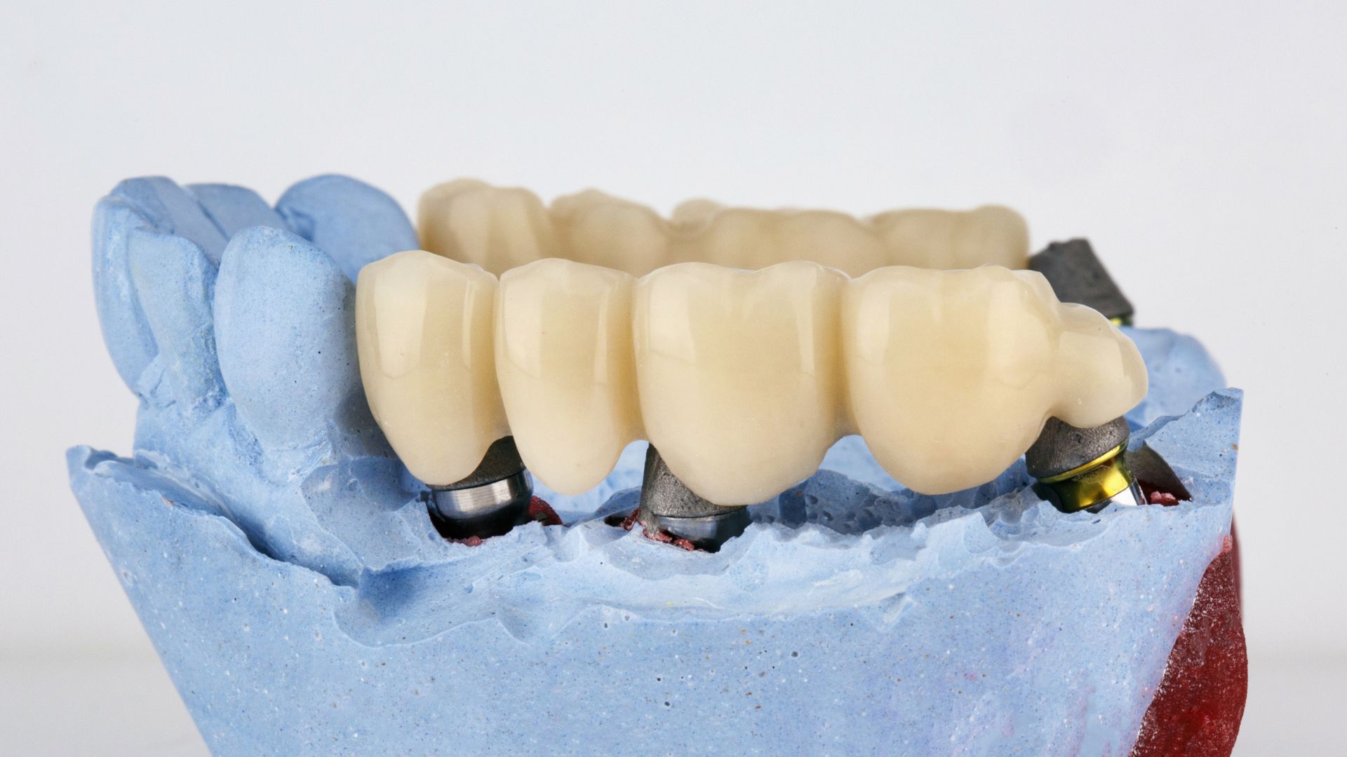 Key Differences Between Crowns and Bridges